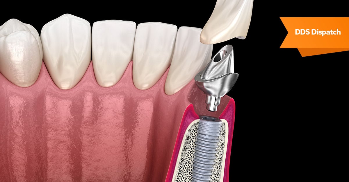 DDS Lab | Dentistry Blog | Dental Implants